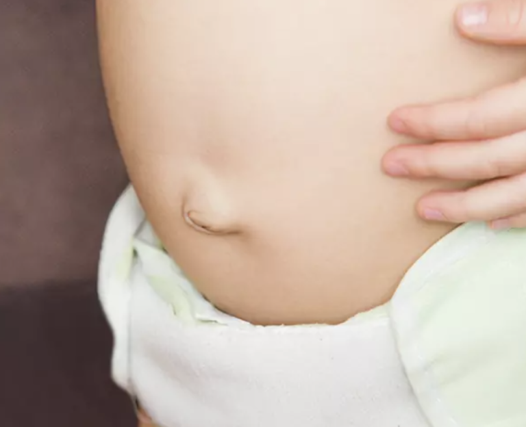 UMBILICAL HERNIA - Hernia Surgery Istanbul